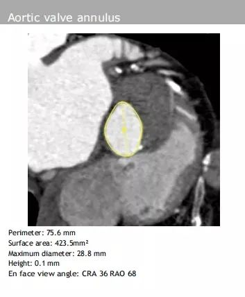 经典病例｜北京大学第三医院唐熠达教授团队圆满完成一站式TAVR+PBMV+PCI手术高龄、高危病例 -- 严道医声网