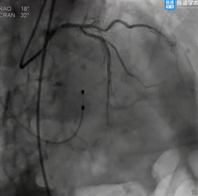 经典病例｜北京大学第三医院唐熠达教授团队圆满完成一站式TAVR+PBMV+PCI手术高龄、高危病例 -- 严道医声网