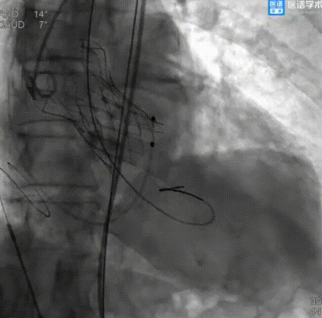 经典病例｜北京大学第三医院唐熠达教授团队圆满完成一站式TAVR+PBMV+PCI手术高龄、高危病例 -- 严道医声网