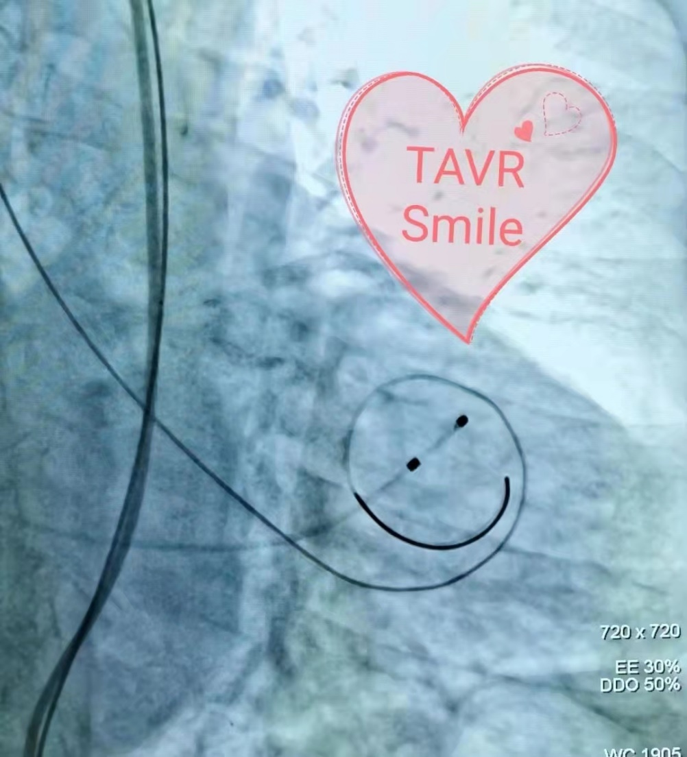 TAVR 20·团队巡礼｜复旦中山葛均波院士结构性心脏病团队 -- 严道医声网
