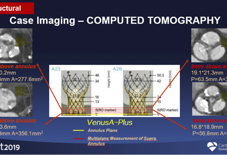 TAVR 20·纪念征文｜王墨扬：侠之大者——诗记2019年受TCT邀约吴永健教授团队完成无造影剂TAVR+PCI一站式手术转播 -- 严道医声网