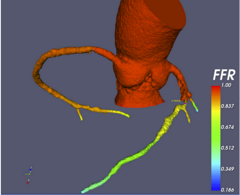TAVR 20·纪念征文｜王墨扬：侠之大者——诗记2019年受TCT邀约吴永健教授团队完成无造影剂TAVR+PCI一站式手术转播 -- 严道医声网