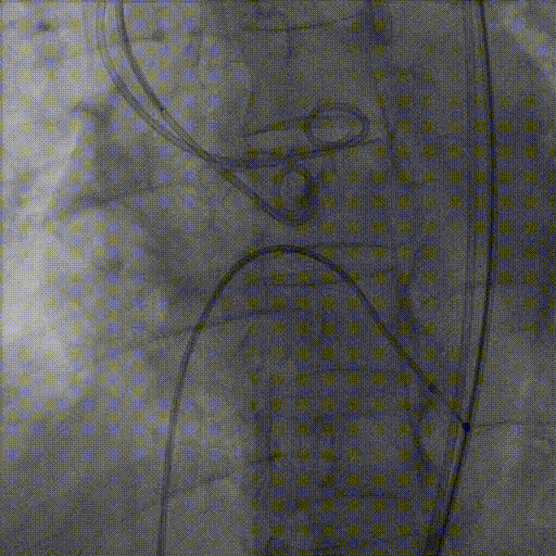 TAVR 20·纪念征文｜王墨扬：侠之大者——诗记2019年受TCT邀约吴永健教授团队完成无造影剂TAVR+PCI一站式手术转播 -- 严道医声网