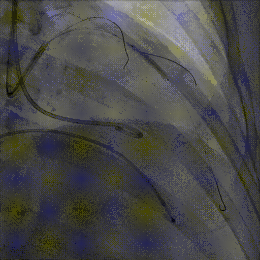 TAVR 20·纪念征文｜王墨扬：侠之大者——诗记2019年受TCT邀约吴永健教授团队完成无造影剂TAVR+PCI一站式手术转播 -- 严道医声网