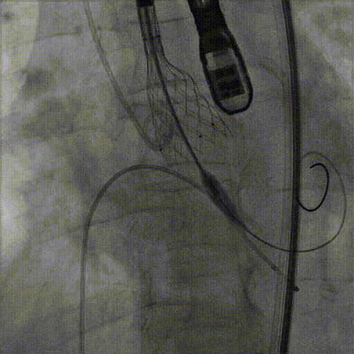 TAVR 20·纪念征文｜王墨扬：侠之大者——诗记2019年受TCT邀约吴永健教授团队完成无造影剂TAVR+PCI一站式手术转播 -- 严道医声网