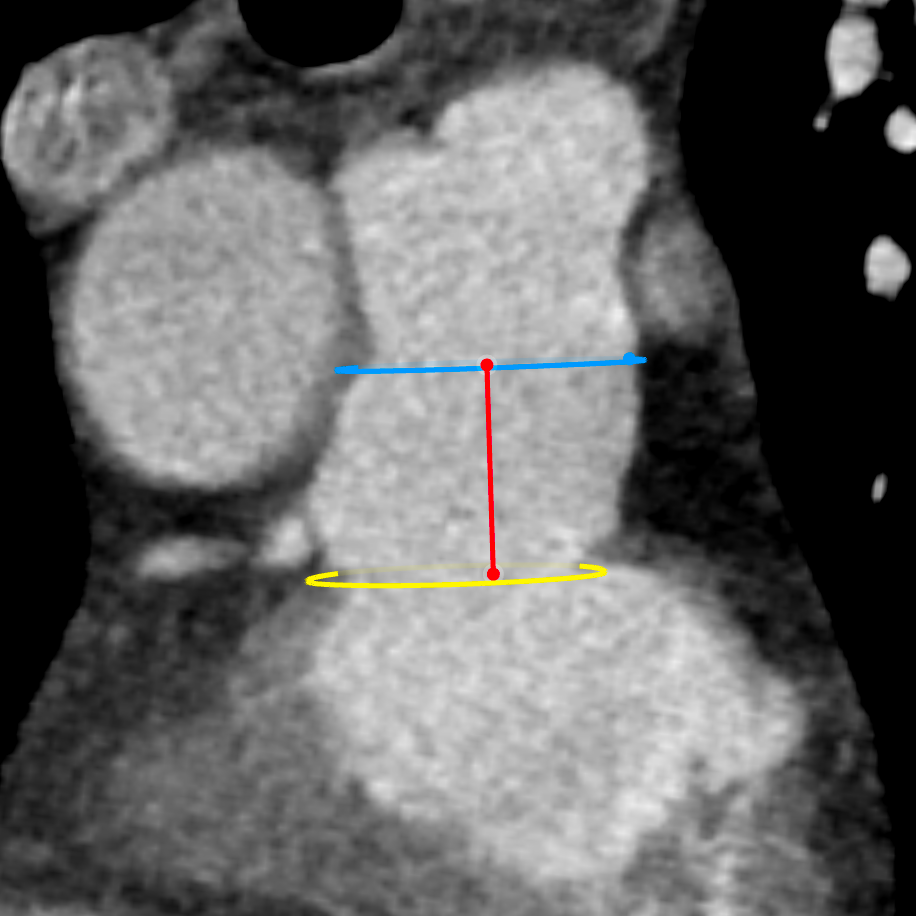 中国结构周2022 | 百折不挠、创新突围——葛均波院士团队克服高难度TPVR困境一例 -- 严道医声网